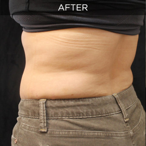 Cellulite And Skin Texture Procedure With Cellutone - Progressive ...